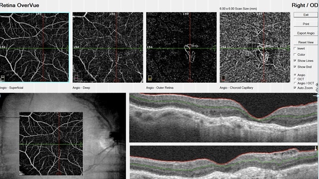 Todo lo que necesita saber sobre la Angio OCT - Fotobiomodulación Macular