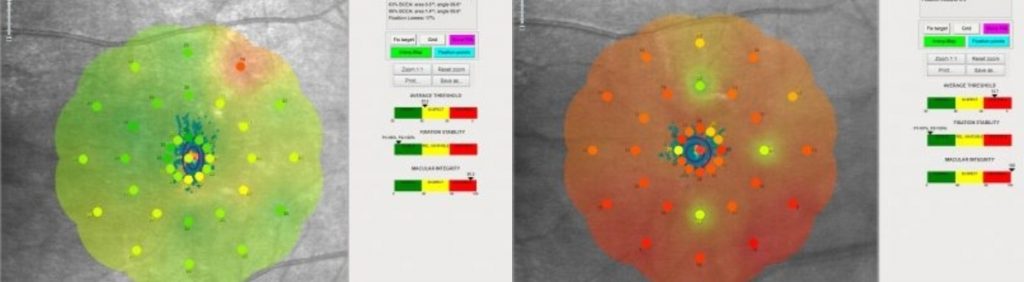 Microperimetría MAIA - Fotobiomodulación Macular