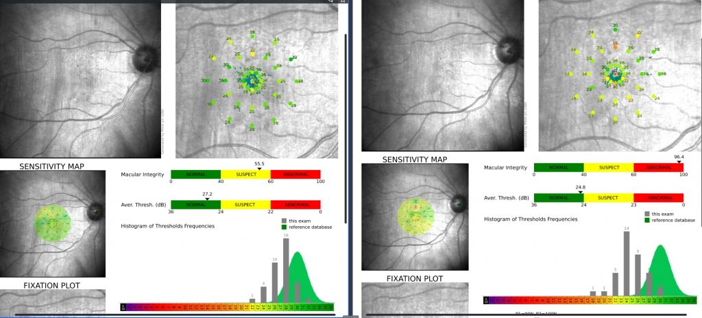 Microperimetría MAIA - Fotobiomodulación Macular
